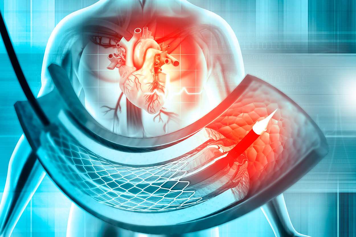 Qué es un cateterismo cardíaco - Cardiopatías Congénitas La Paz